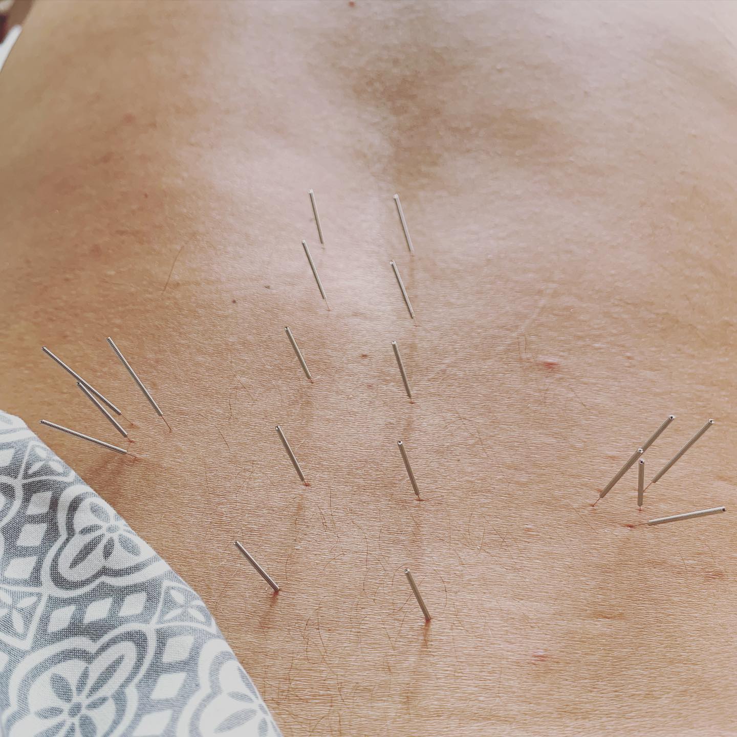 Acupuncture for Low Back Pain & Degenerative Disc Disease – Acupuncture ...