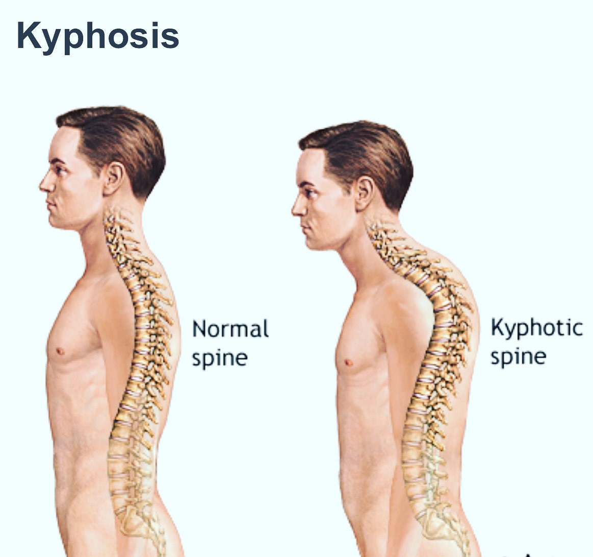 Acupuncture for Kyphosis – Acupuncture Nirvana